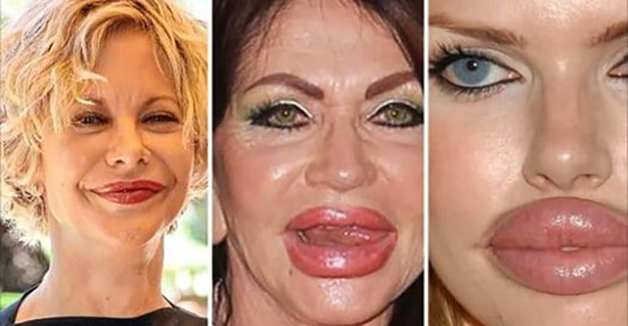 CELEBRIDADES: 10 casos em que a REMODELAÇÃO LABIAL deram MUITO ERRADO