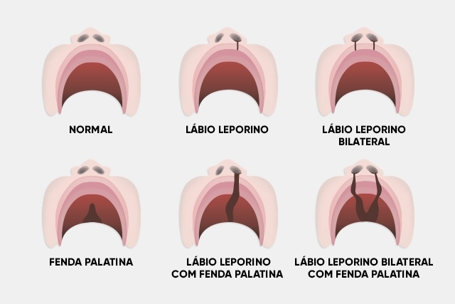 5 ATITUDES QUE AUMENTAM AS CHANCE DO SEU FILHO TER LÁBIO LEPORINO